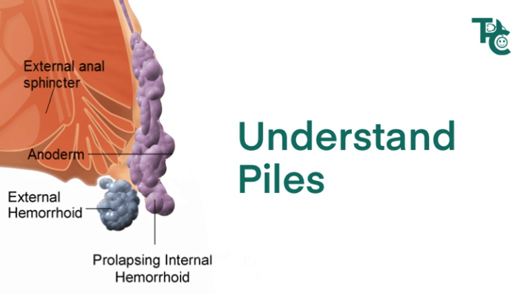 What are Piles (hemorrhoids) ? Different Stages of Piles