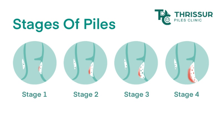 What are Piles (hemorrhoids) ? Different Stages of Piles