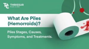 What are Piles (hemorrhoids) ? Different Stages of Piles