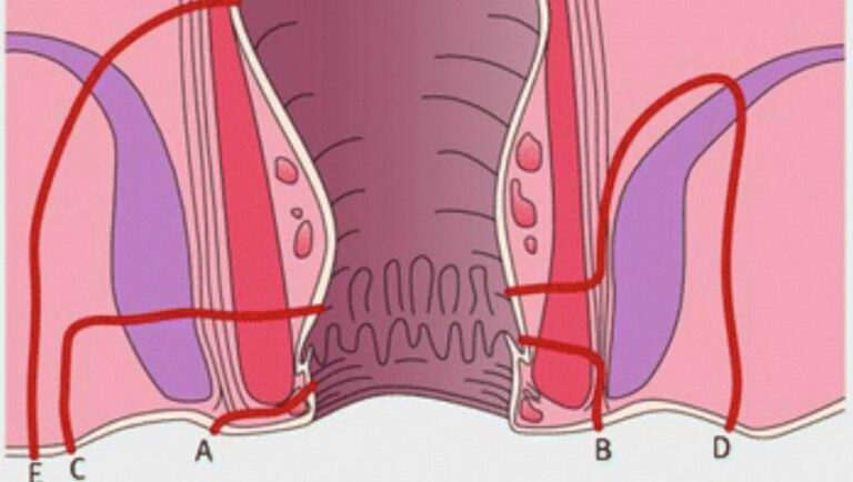 Transsphincteric Fistula Treatment: Fixcision by Dr. Raviram S.