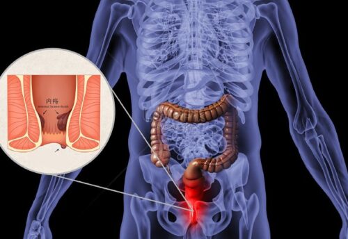 Perianal Abscess Recurrence: Common? Why Treat? | Dr. Raviram S.