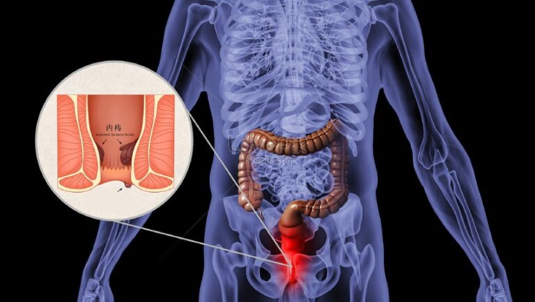 Are You Sure You Have Hemorrhoids? Common Conditions Often Mistaken for ...